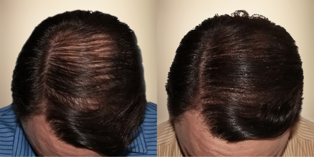 Follicular Unit Extraction - North Atlanta Hair Restoration