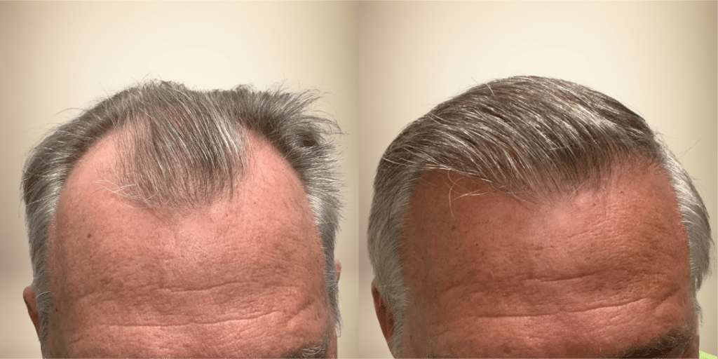 PDO Threads - North Atlanta Hair Restoration