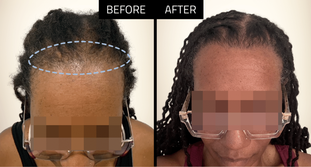 What Is DHI Hair Transplantation? - North Atlanta Hair Restoration