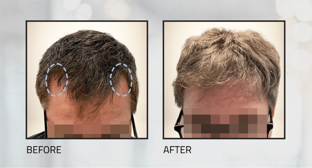 Understanding Shave-Less FUE Hair Transplants